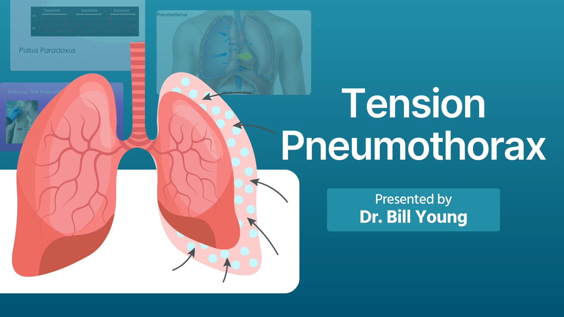 Tension Pneumothorax: Recognizing and Managing the Threat - EMT Review